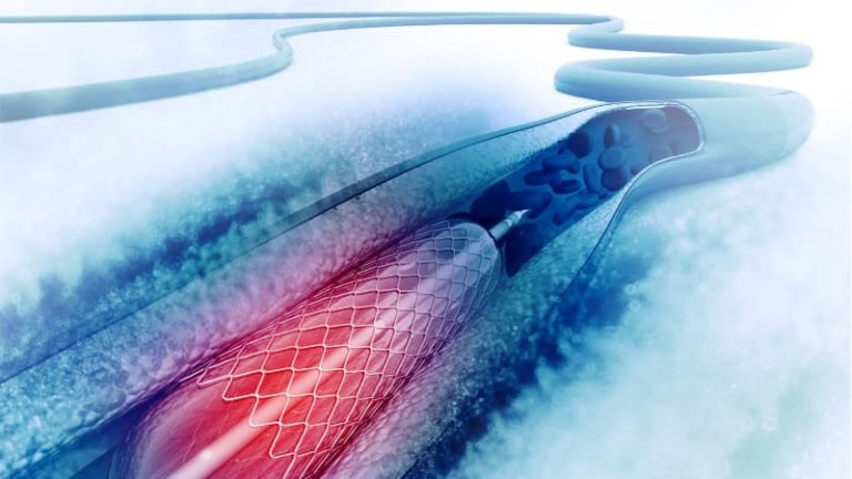 DAPT療法とは？押さえておきたい2つの適応 | KusuriPro-くすりがわかる！薬剤師ブログ